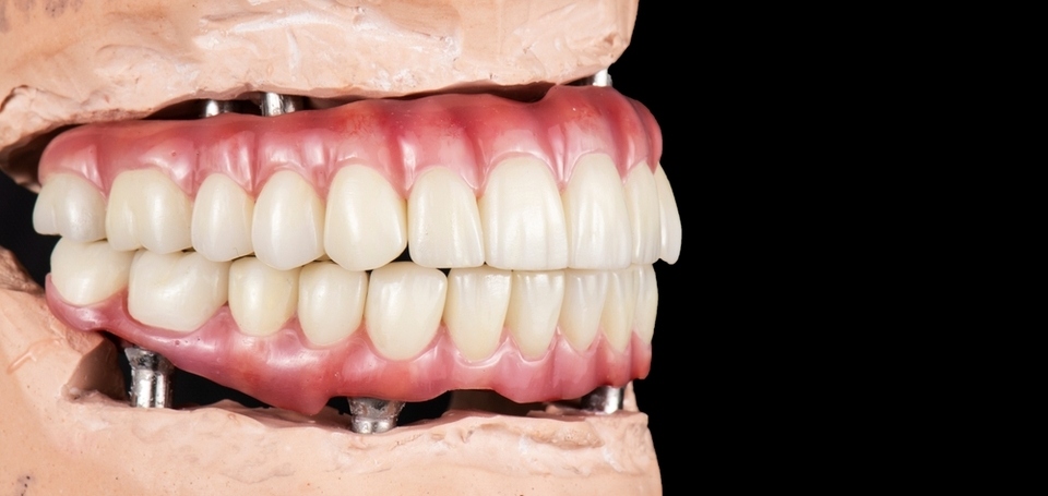 Hybrid Dentures in Tulsa, OK | Hybrid Dentures Near Me